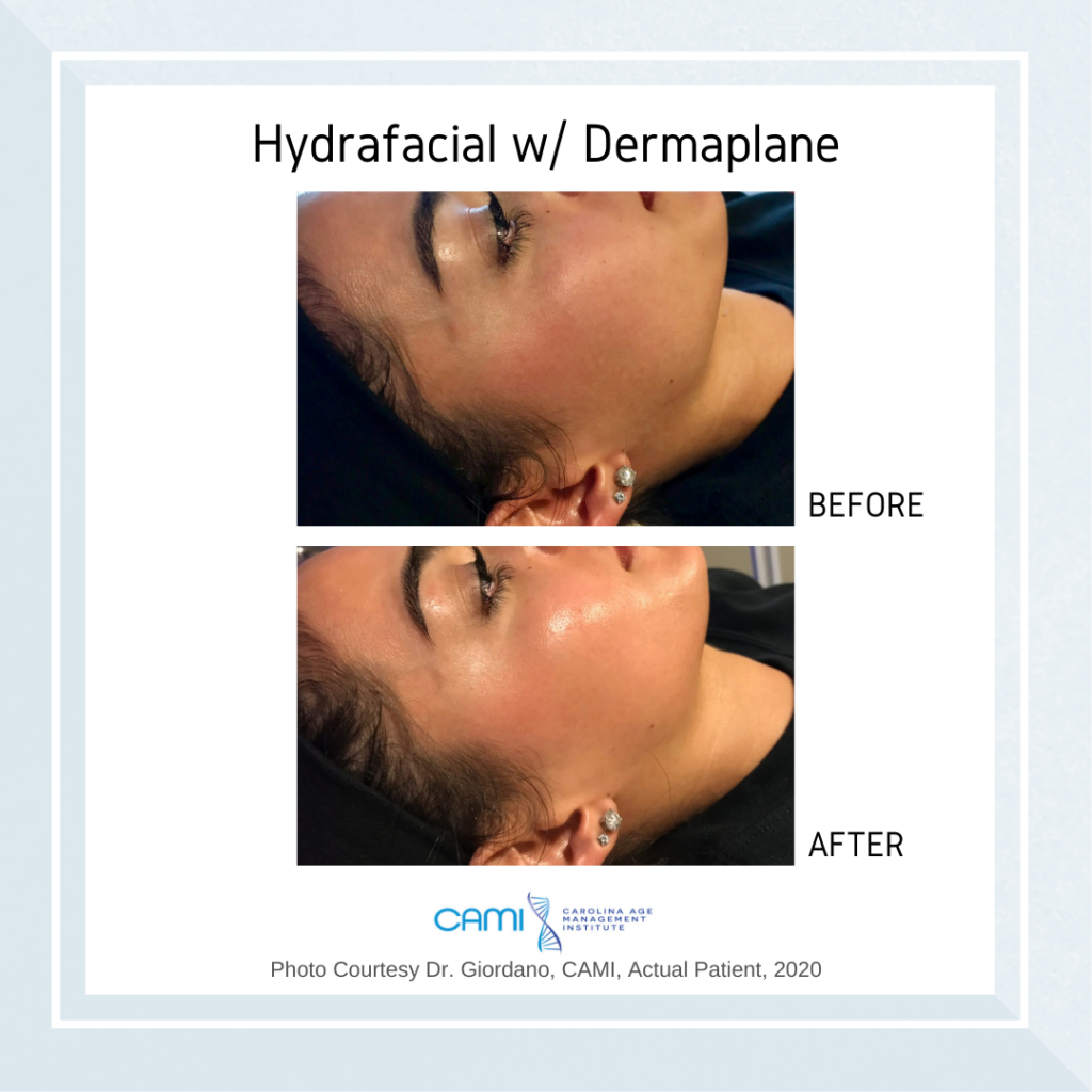 HydraFacial vs Microdermabrasion: Which One Is Right For You? | CAMI